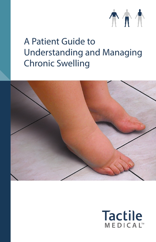 Patient Guide: Understanding & Managing Chronic Swelling | Tactile Medical