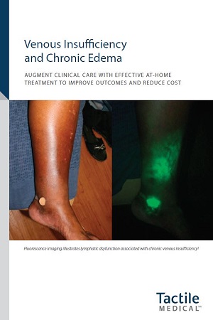 Venous Insufficiency and Chronic Edema Brochure - Tactile Medical