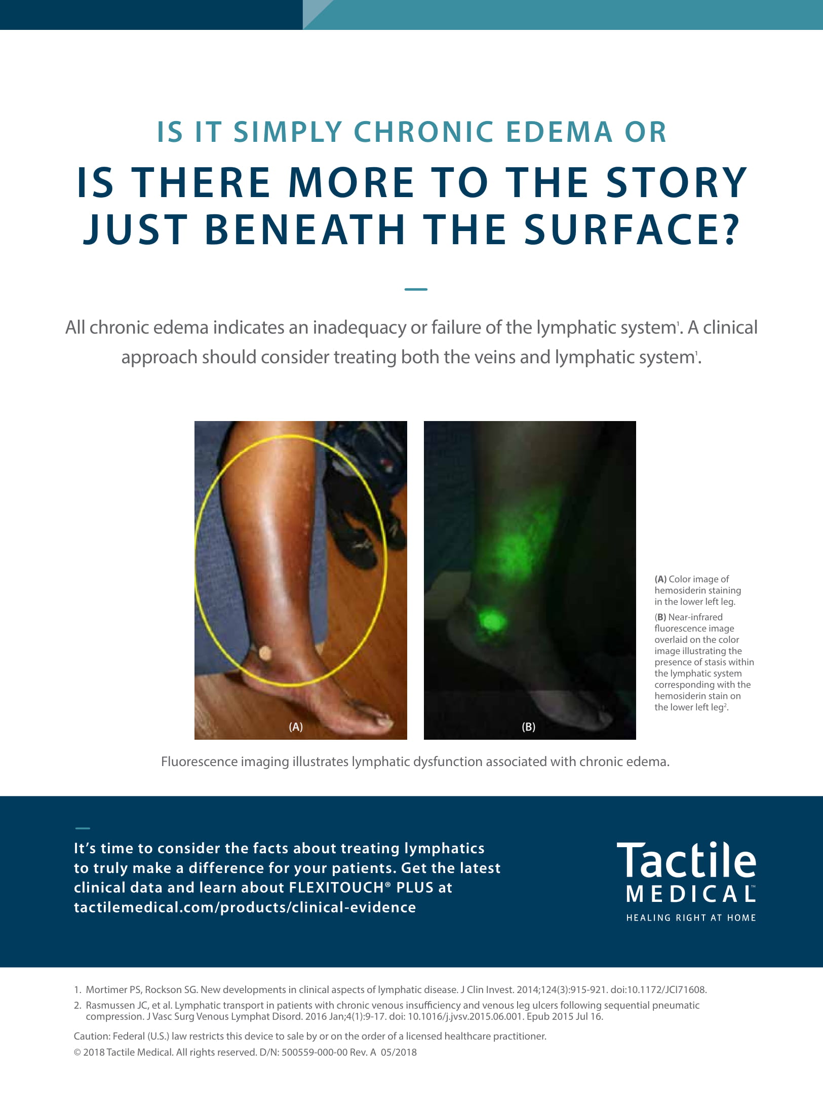 Chronic Edema: Not Just a Venous Issue - Tactile Medical