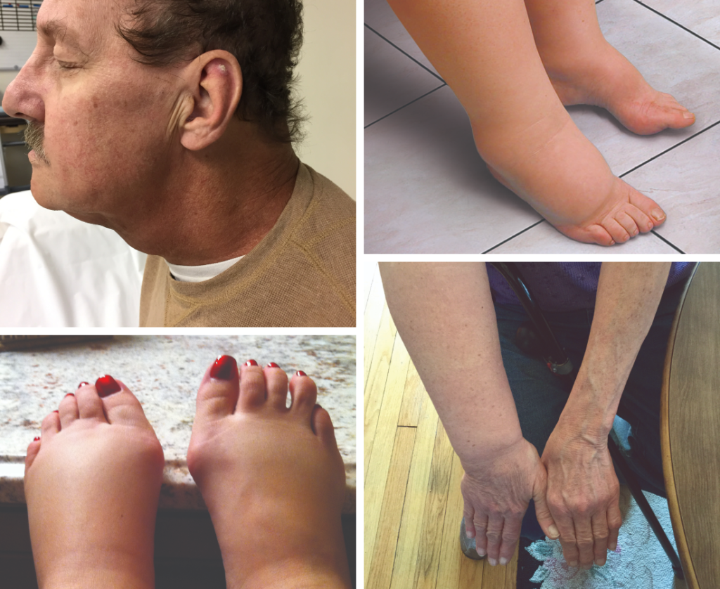 Lymphedema And Chronic Venous Insufficiency Resources For Clinicians Lymphedema And Chronic Venous Insufficiency Resources For Clinicians
