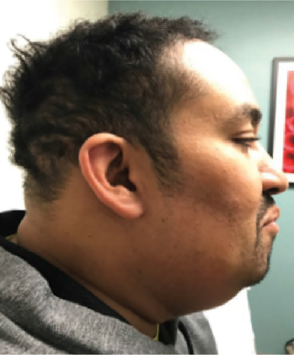 Treat Cancer Related Head and Neck Swelling at Home - Flexitouch Plus