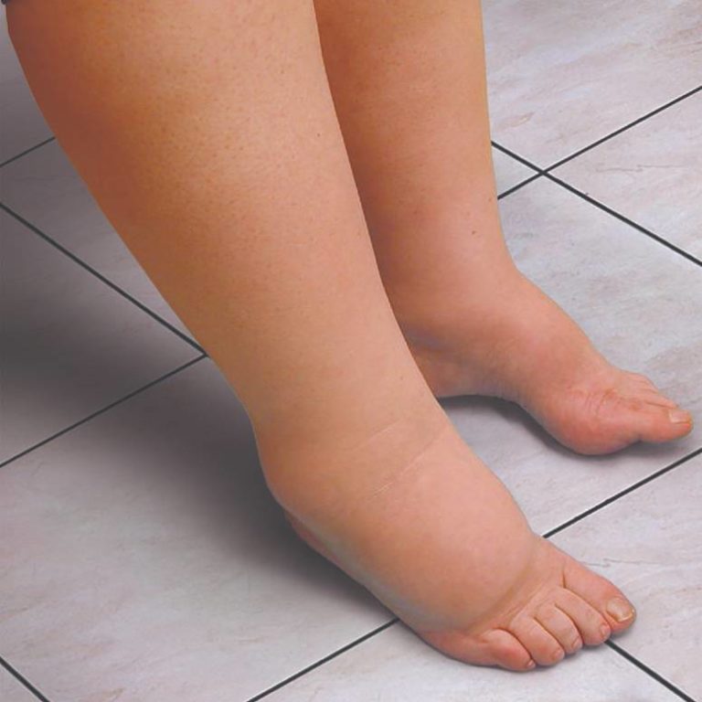 What is Lymphedema? Causes and Treatments of Lymphedema | Tactile Medical