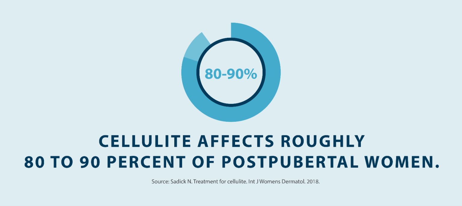 What you Need to Know About Lipedema - Tactile Medical