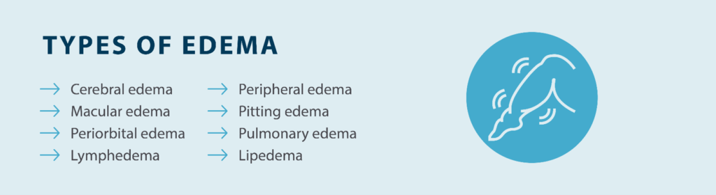 Edema Guide: What Is Edema? - Tactile Medical