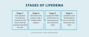 Lipedema Fibrosis: Everything You Need to Know - Tactile Medical