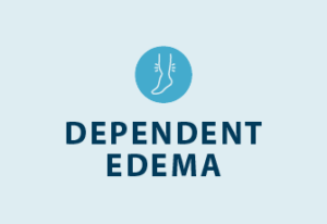 Dependent Edema: Symptoms, Causes, Treatment & More - Tactile Medical