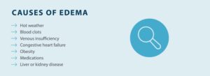 Measuring Edema: How Do You Measure Edema? - Tactile Medical