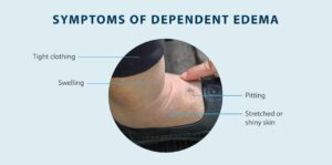 Dependent Edema: Symptoms, Causes, Treatment & More - Tactile Medical