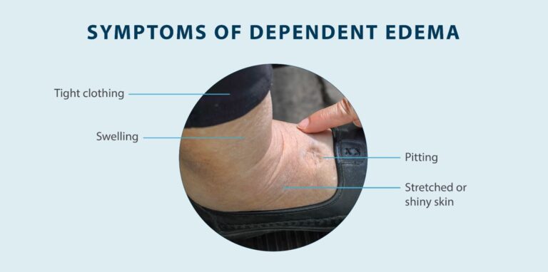 Dependent Edema: Symptoms, Causes, Treatment & More - Tactile Medical