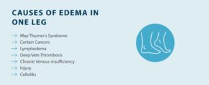 Edema in One Leg: What Causes Swelling in One Leg Only? | Tactile Medical