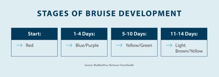 Edema Bruising: Causes, Symptoms & Treatment - Tactile Medical