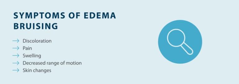 Edema Bruising: Causes, Symptoms & Treatment - Tactile Medical