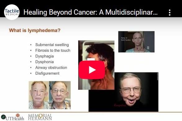 Healing Beyond Cancer: Managing Head & Neck Lymphedema Together ...