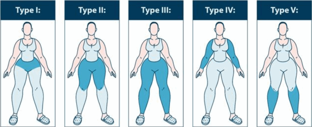What is Lipedema? Lipedema Causes & Treatments | Tactile Medical