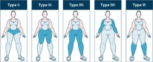 What is Lipedema? Lipedema Causes & Treatments | Tactile Medical
